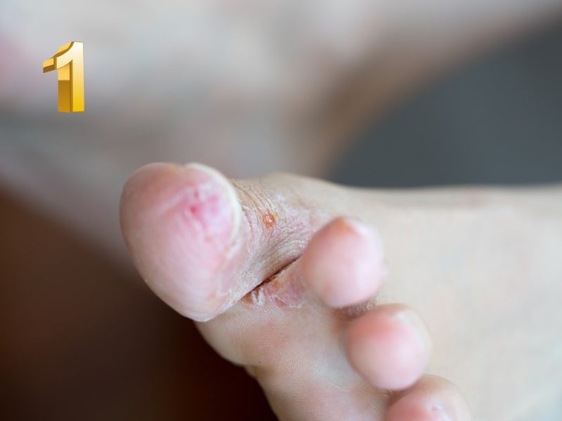 Infezioni fungine dei piedi: come riconoscerle e quali sono i ...